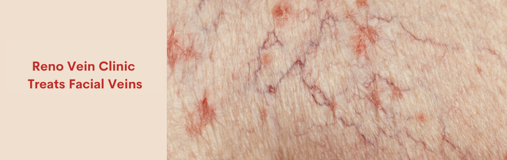 Facial Spider Veins - Reno Vein Clinic